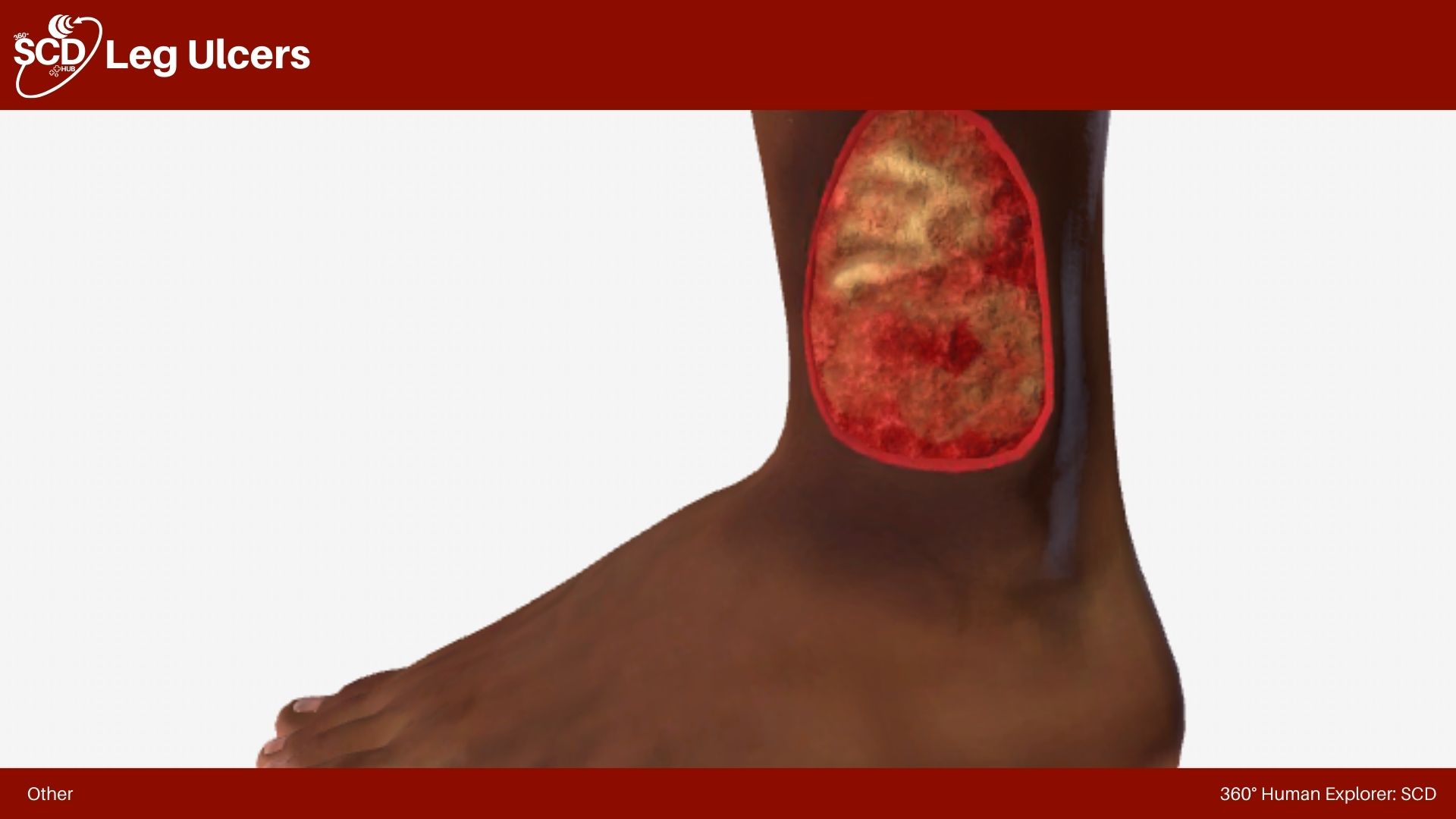Leg Ulcers – 360° SCD Hub