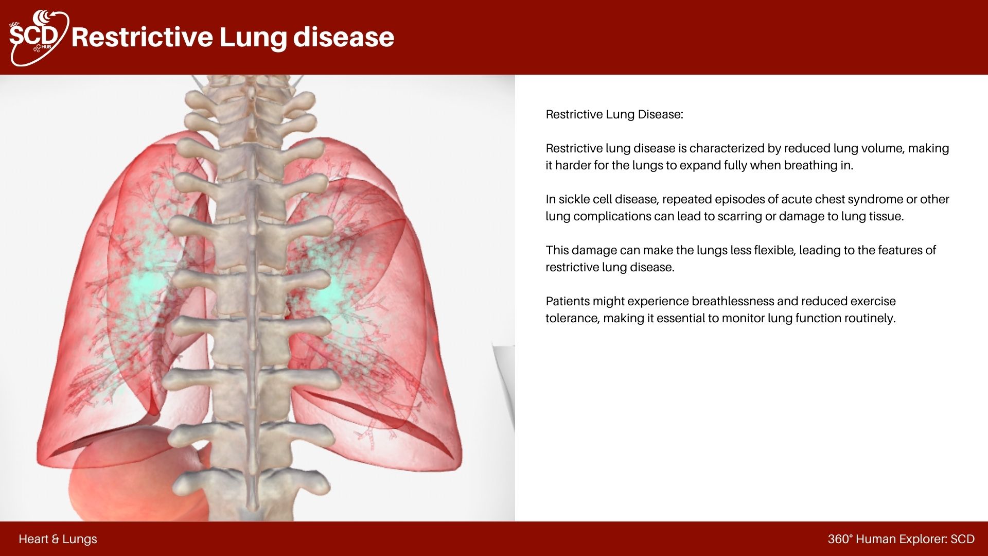 Restrictive Lung disease – 360° SCD Hub