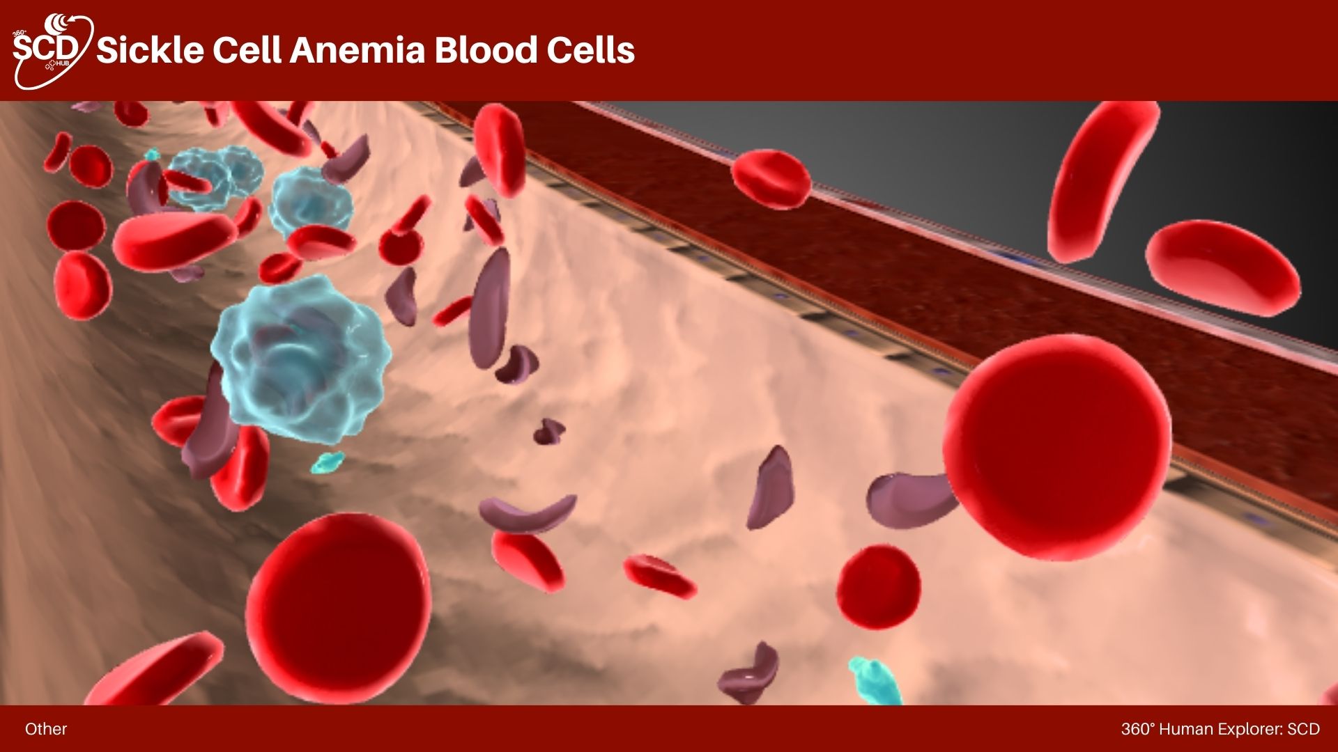 Sickle Cell Anemia Blood Cells – 360° SCD Hub
