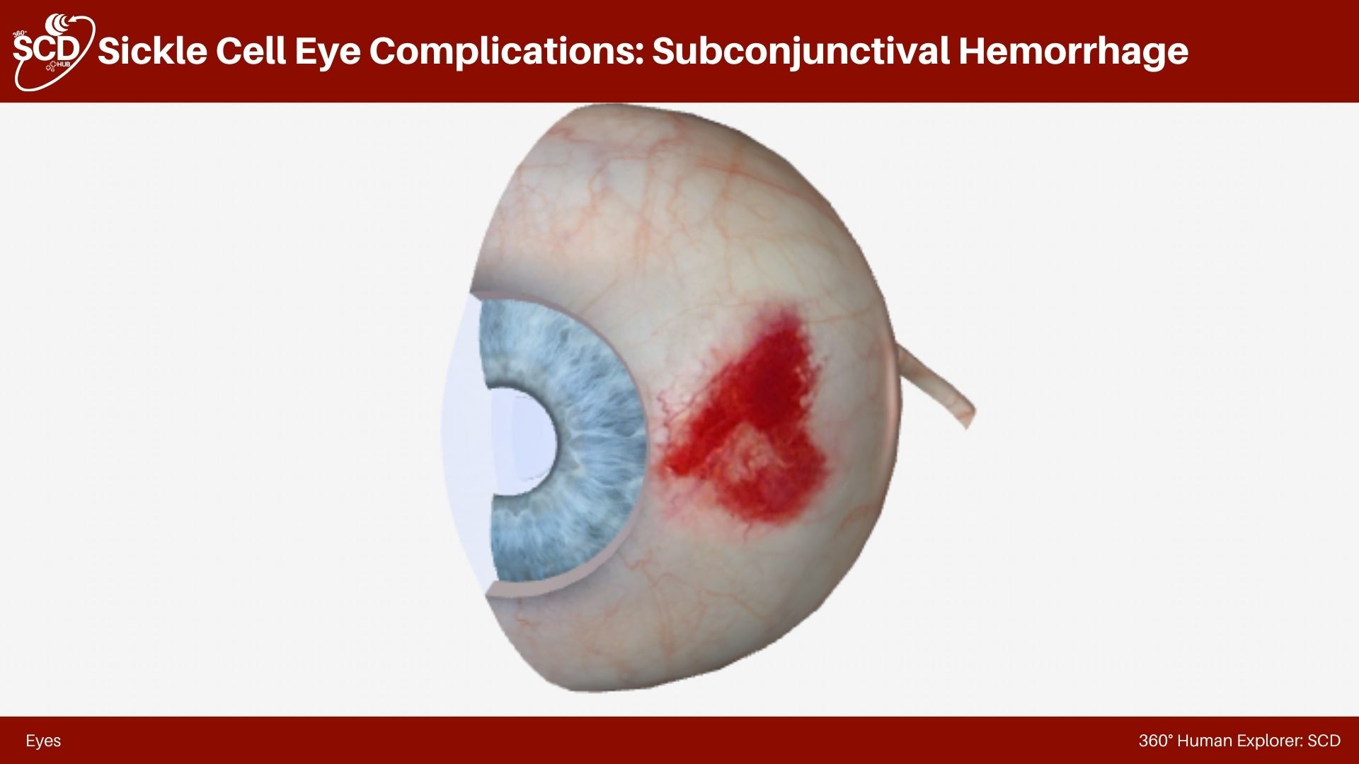 Sickle Cell Eye Complications: Subconjunctival Hemorrhage – 360° SCD Hub