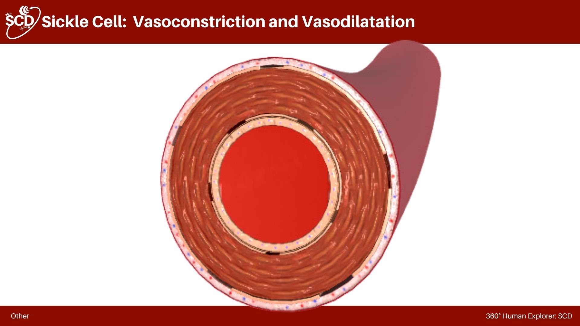 Sickle Cell: Vasoconstriction and Vasodilatation – 360° SCD Hub